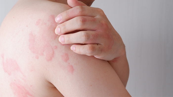 Supporting customers with chronic idiopathic urticaria
